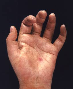 Tangents: Stigmata of Endocarditis